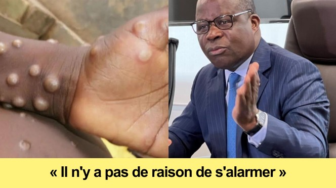 Le district de Dianra touché : Mpox en Côte d'Ivoire - Notre Continent